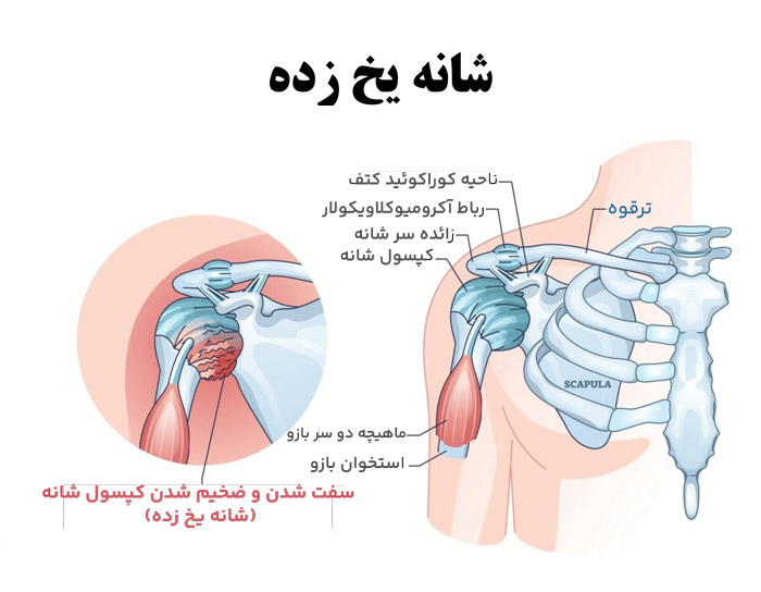 شانه یخ زده علل، علائم، تشخیص و درمان درمان تزریقی و جراحی شانه